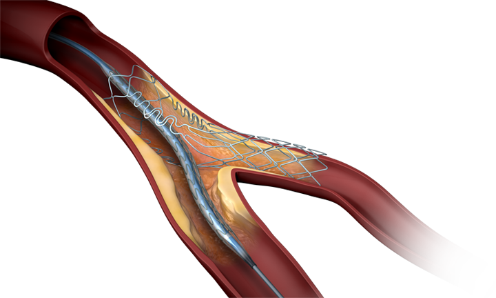 Pivotal Trial Outcomes | Tryton Medical